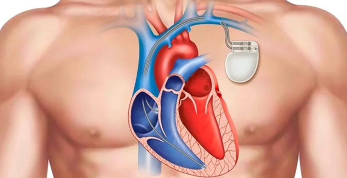 Pacemaker Doctor Pacemaker Doctor